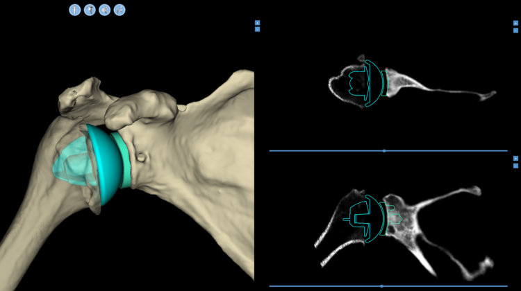 Dr Kevin Kruse | Shoulder Specialist Dallas, TX | Rotator Cuff Repair ...